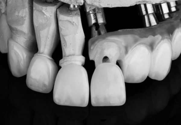 Biomateriales en odontología: El futuro de las restauraciones